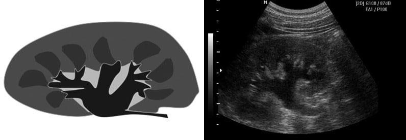 Hidronefroses no periodo pós natal: Causas e Classificação