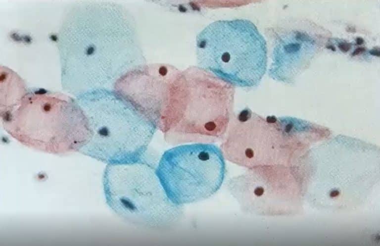 Lesões por HPV: quais são as principais condutas de tratamento?