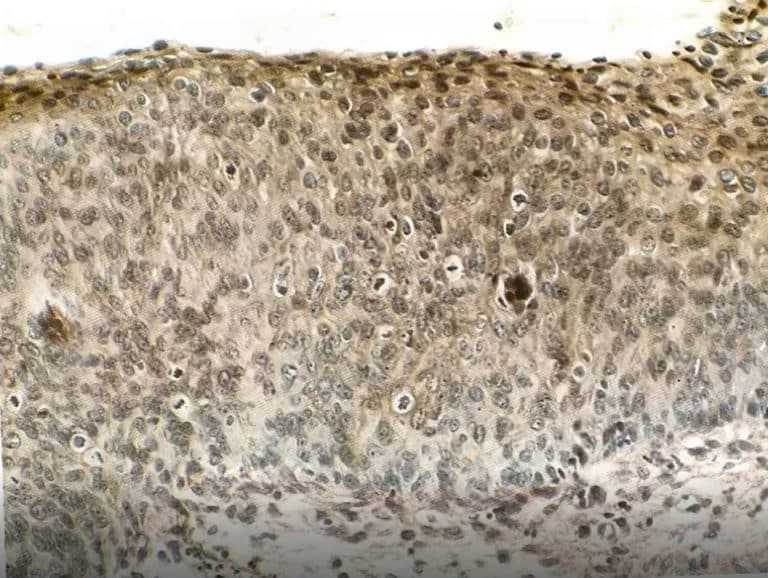 Lesões por HPV: quais são as principais condutas de tratamento?