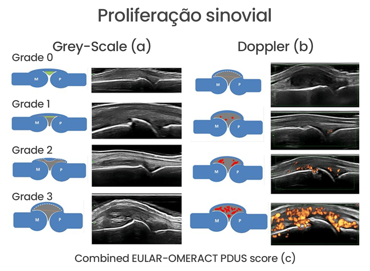 Sinovite: diagnóstico clínico e por imagem das doenças articulares