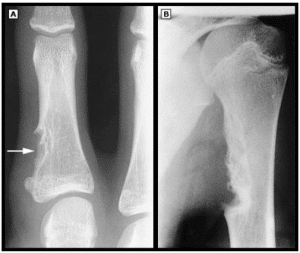 Diagnóstico de osteocondroma: sinais no exame de imagem