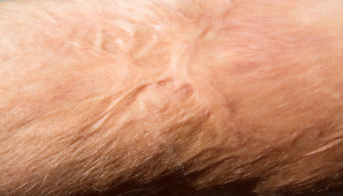 Tratamento de retrações cicatriciais: o que preciso saber para prática ...