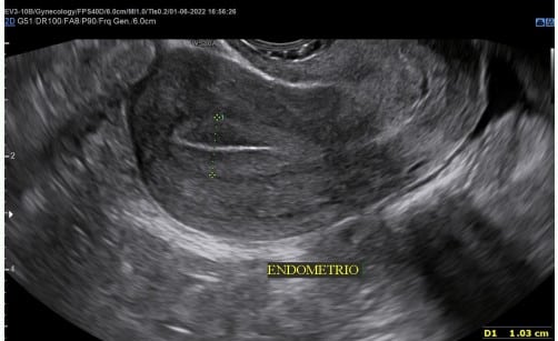 Ultrassom Ecogenico O Que é Isso Nesse Ultrassom De