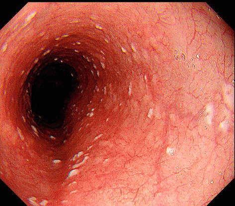Identificação das principais patologias esofágicas pela endoscopia