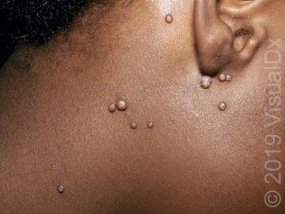 As 10 lesões dermatológicas pediátricas mais comuns